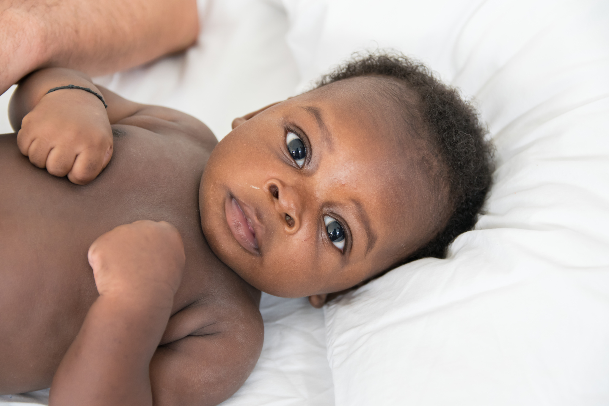 De Ponseti-methode | Duurzame hulp | Mercy Ships